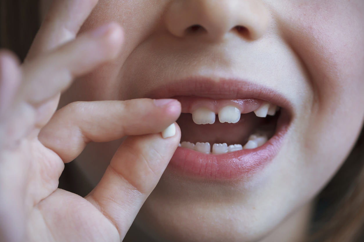 Losing Teeth: What Parents Should Expect